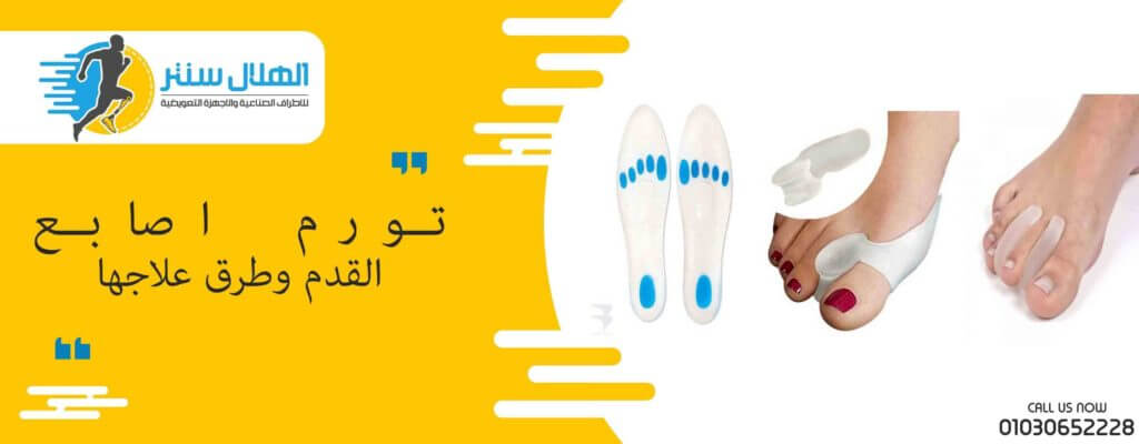تورم اصابع القدم واستخدام الاحذية الطبية الهلال سنتر اطراف صناعية